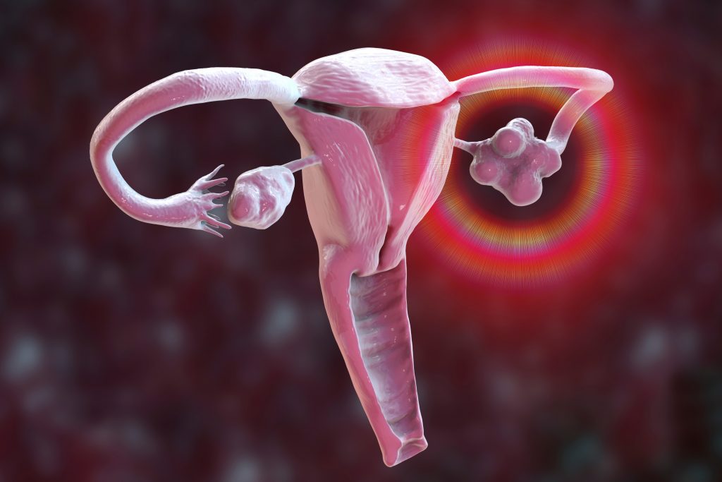 What Is PCOS PCOS Symptoms Causes Diagnosis And Treatment KJK